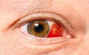 Qu’est ce que l’hémorragie sous conjonctivale | OPH 78